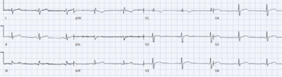 Unstable tachycardia, cardiovert? | ECG Cases | Emergency Medicine Cases