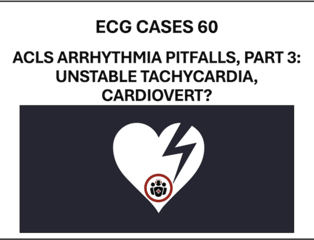 TIA Update - Risk Stratification, Workup, Dual Antiplatelet Therapy ...