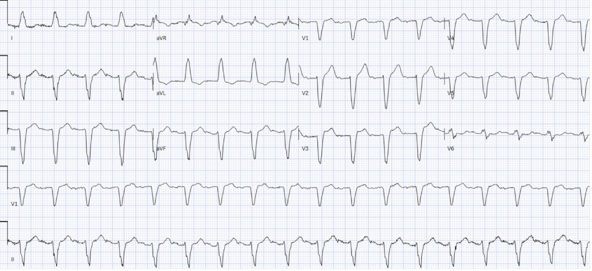 ACLS arrhythmia pitfalls: Wide Complex Tachycardia | ECG Cases ...