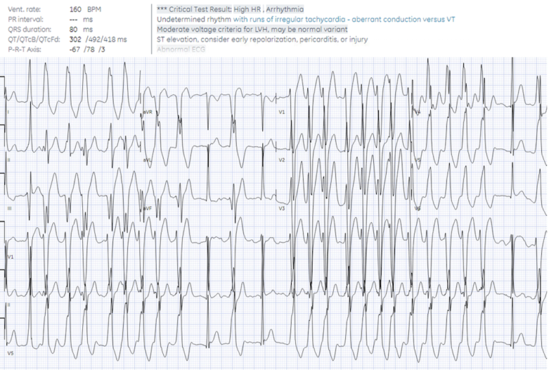 ACLS arrhythmia pitfalls: Wide Complex Tachycardia | ECG Cases ...