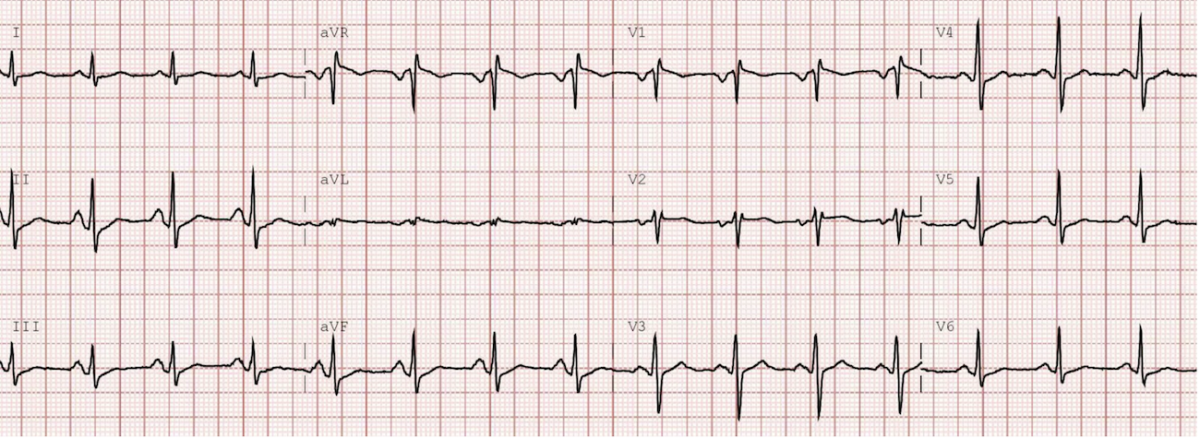 ACLS arrhythmia pitfalls, part 5: Stable Narrow Complex Tachycardia