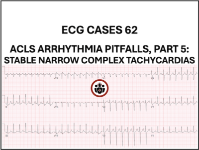 ACLS arrhythmia pitfalls, part 5: Stable Narrow Complex Tachycardia
